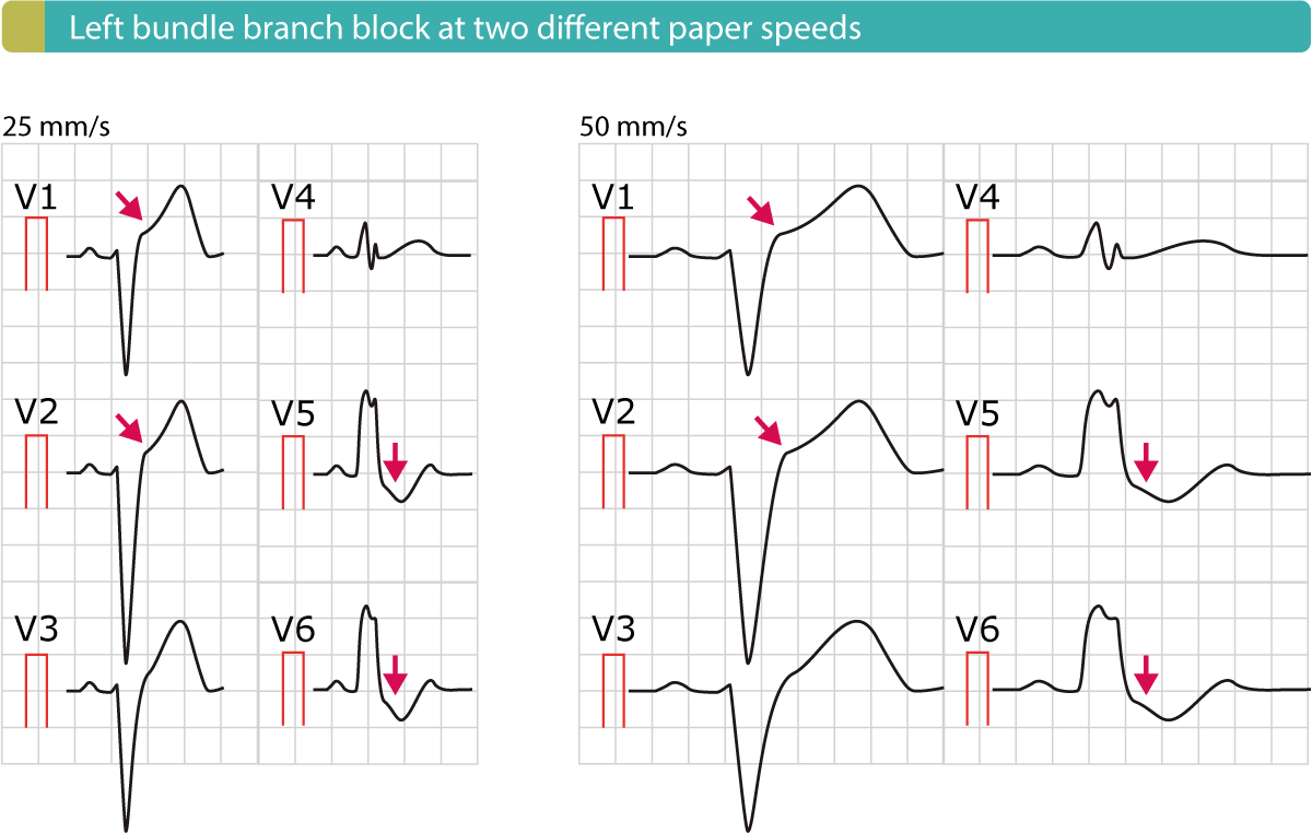 ST-elevasjon ved akutt myokardiskemi og differensialdiagnoser ...