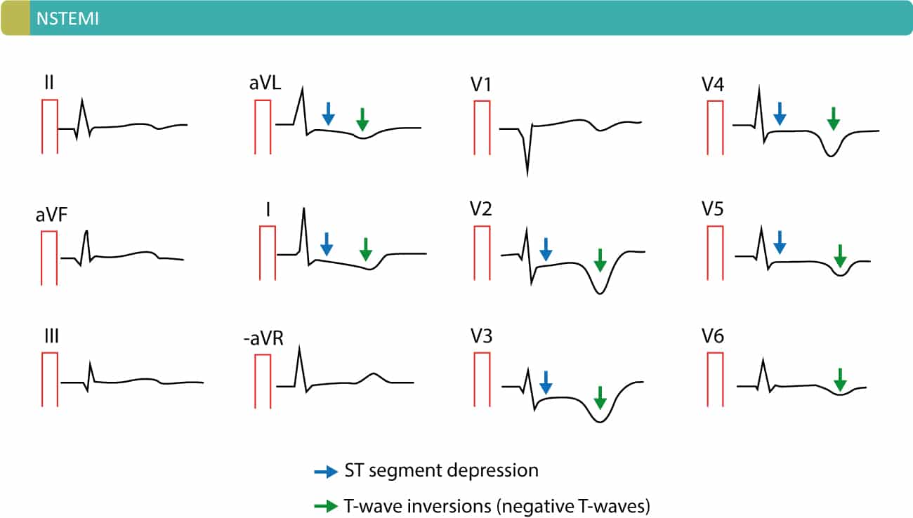 NSTEMI (hjerteinfarkt uten ST-elevasjon) og ustabil angina: Diagnose ...