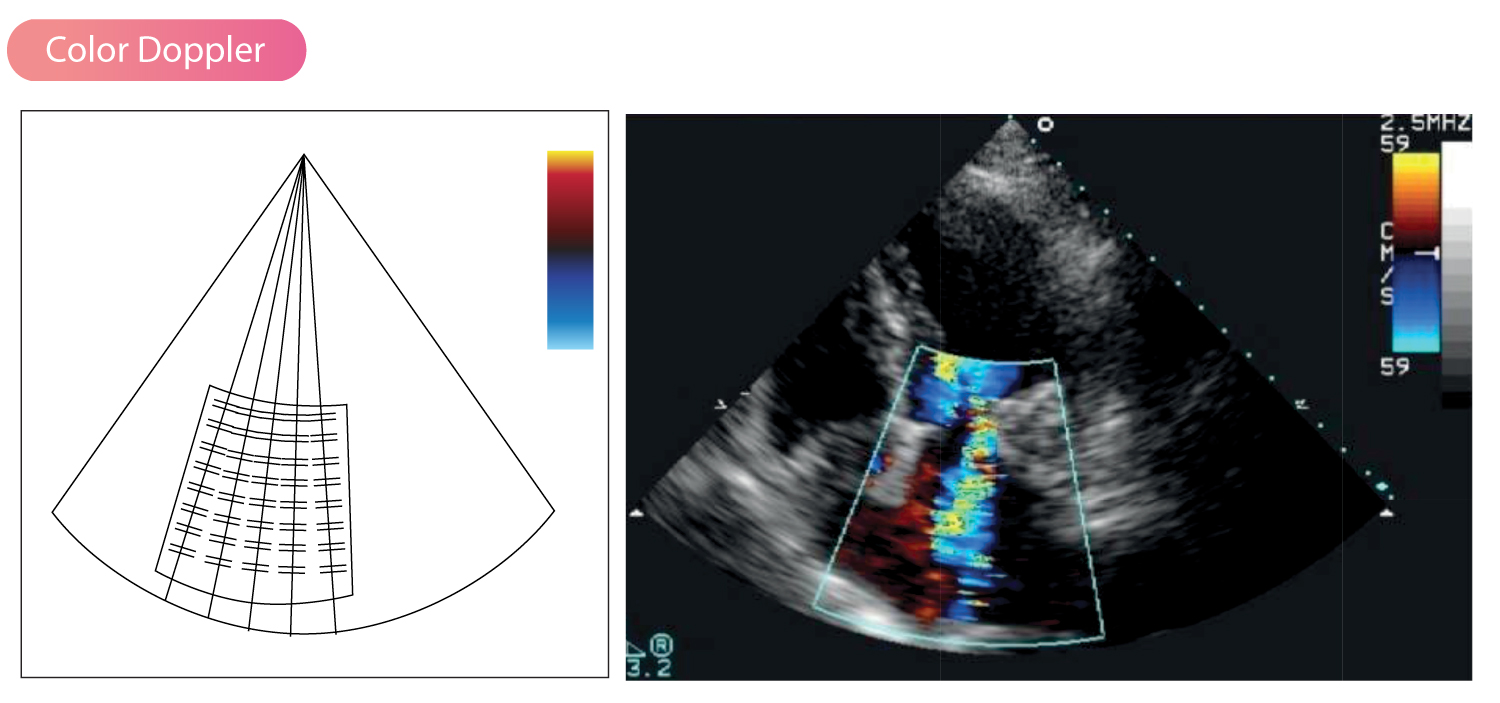 Fargedoppler – Kardiologi Online
