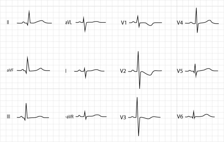 Tolkning av elektrokardiogram (EKG) hos nyfødte og barn – Kardiologi Online