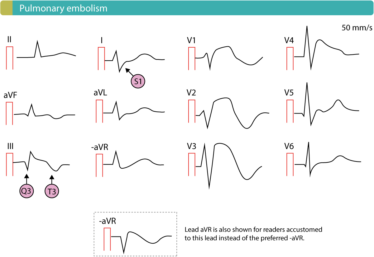 Lungeemboli (PE): Årsaker, symptomer, diagnose, behandling