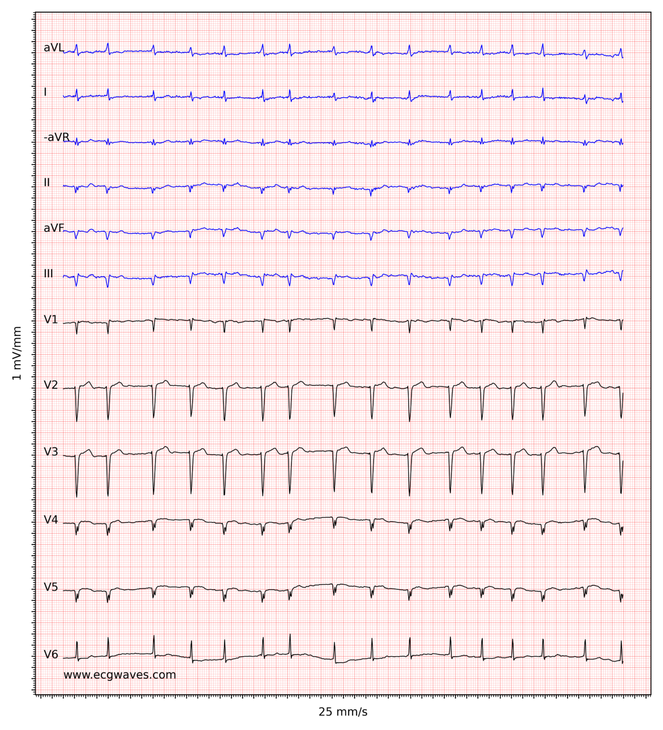 Atrieflimmer: EKG, klassifisering, årsaker, risikofaktorer og ...