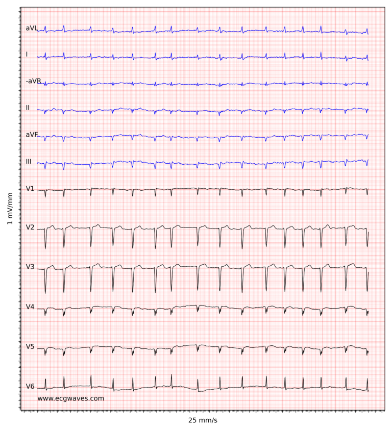 Atrieflimmer: EKG, klassifisering, årsaker, risikofaktorer og behandling – Kardiologi Online
