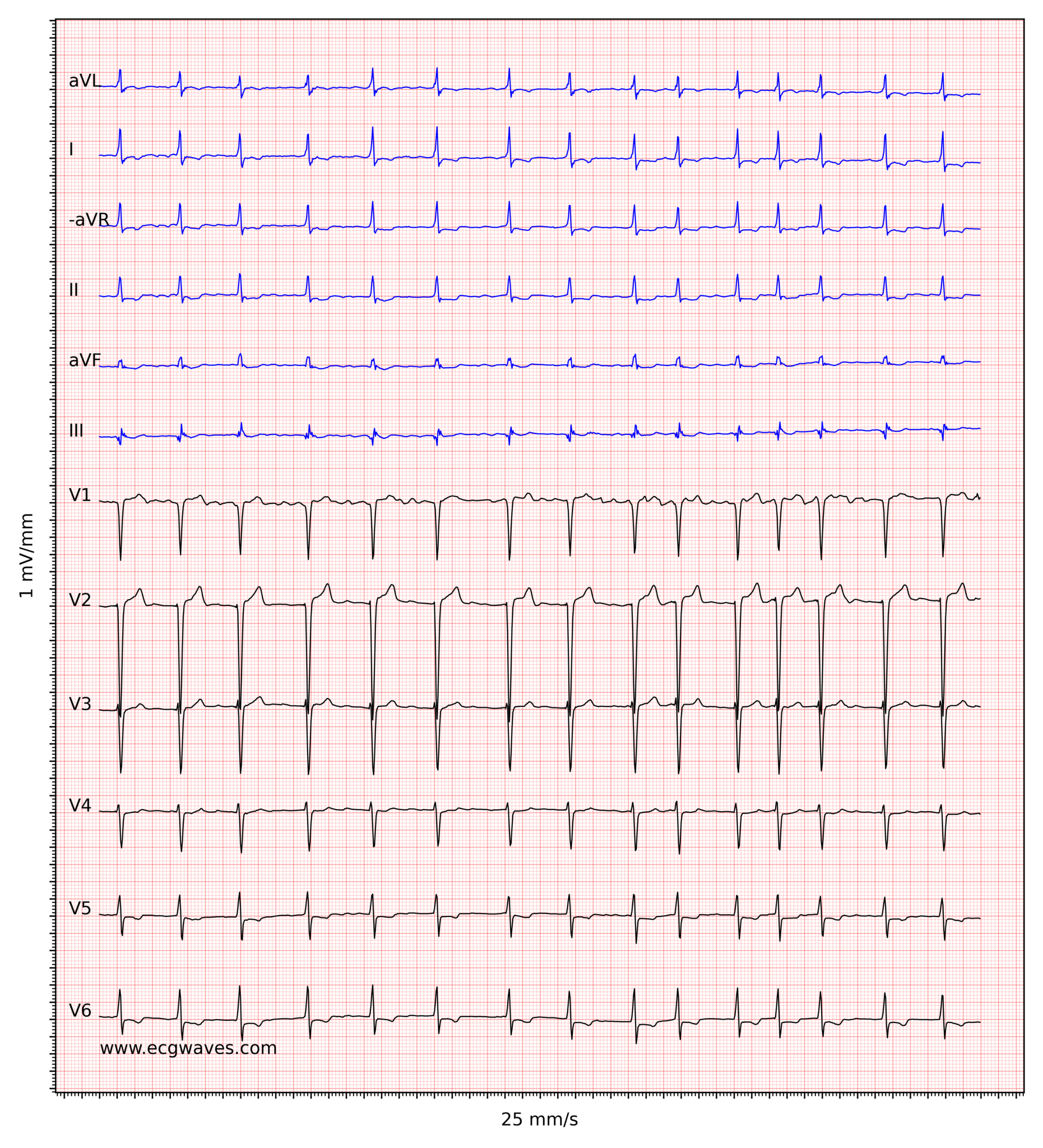 Atrieflimmer: EKG, klassifisering, årsaker, risikofaktorer og ...