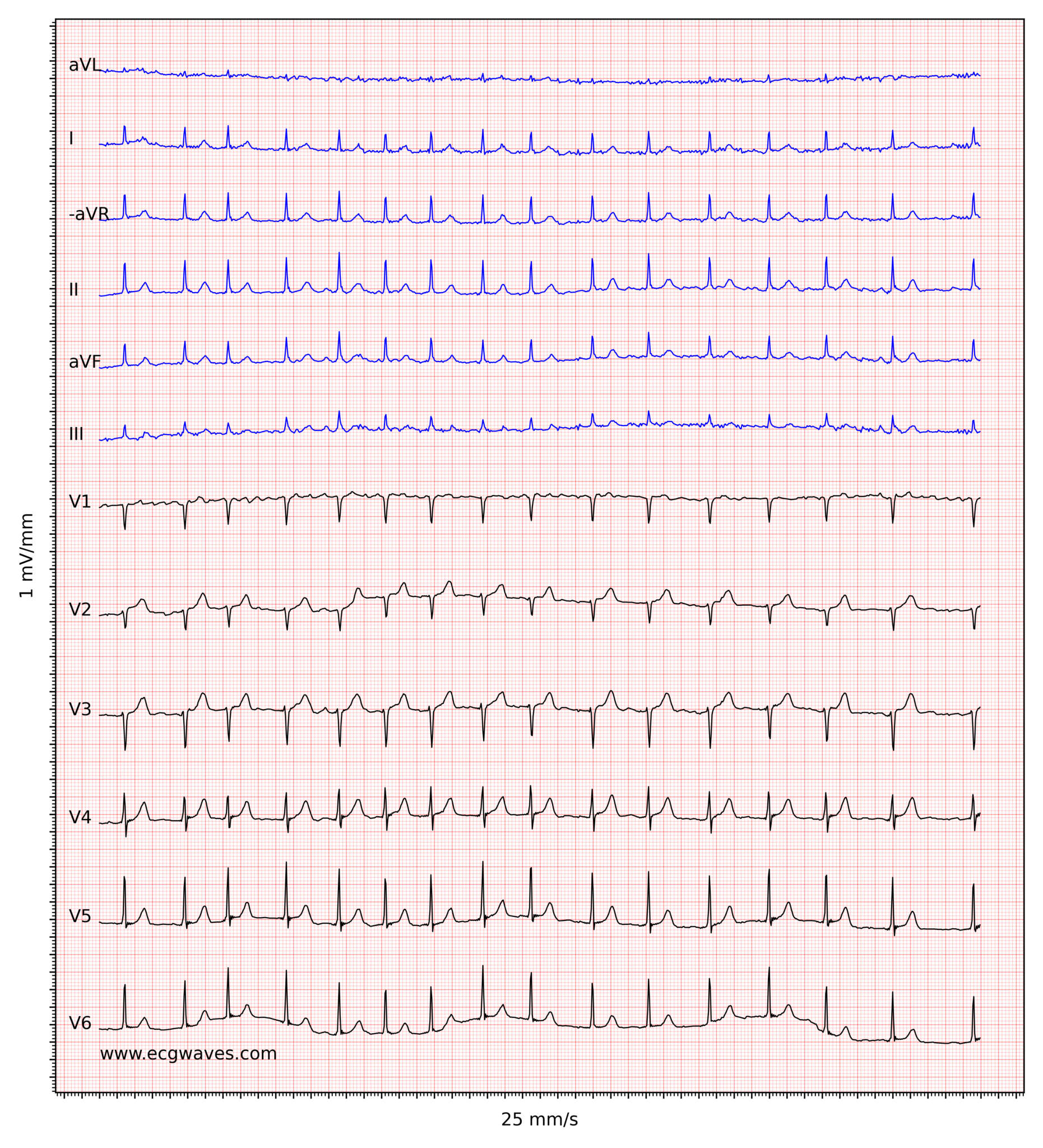Atrieflimmer: EKG, klassifisering, årsaker, risikofaktorer og behandling – Kardiologi Online