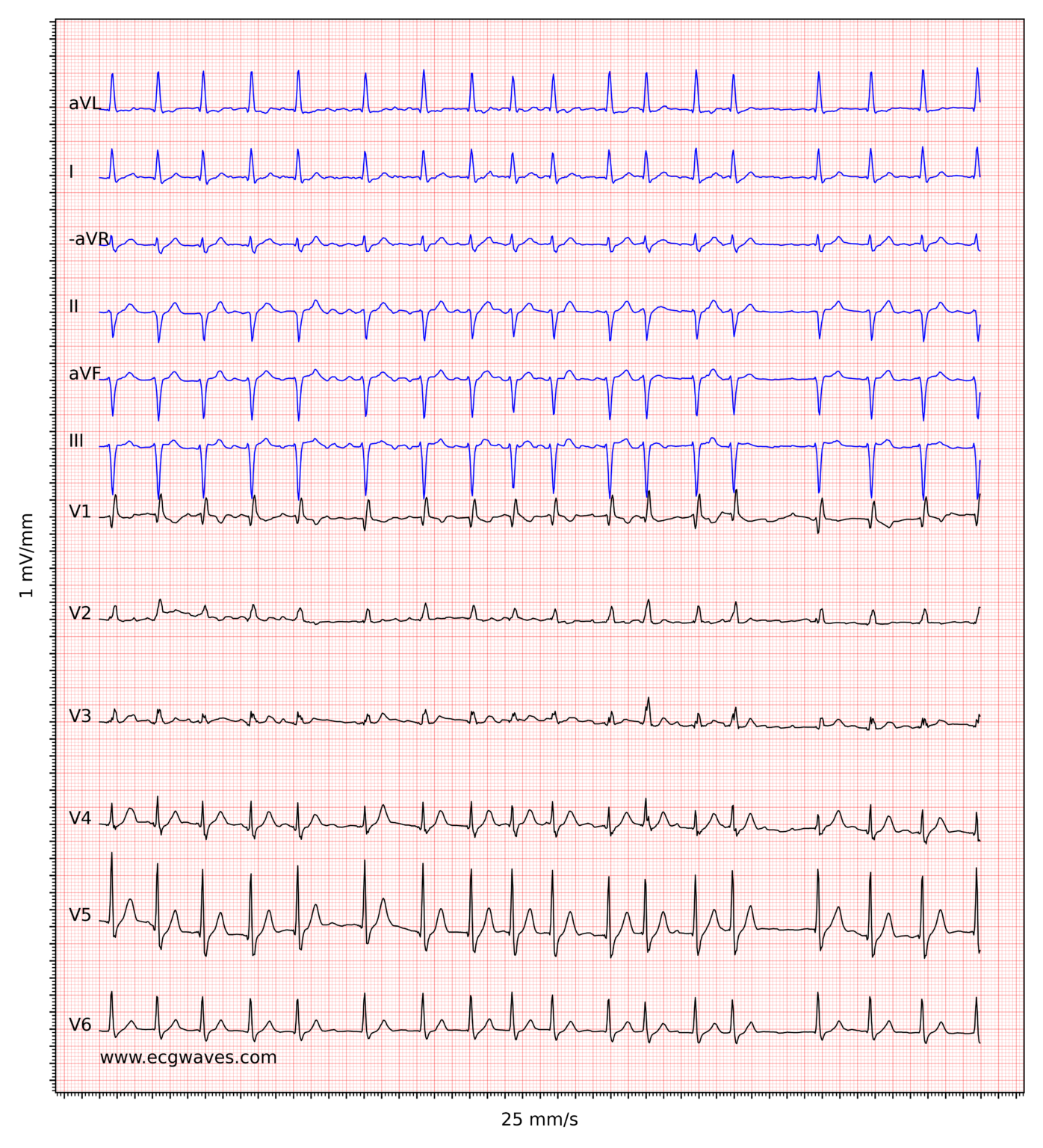 Atrieflimmer: EKG, klassifisering, årsaker, risikofaktorer og ...