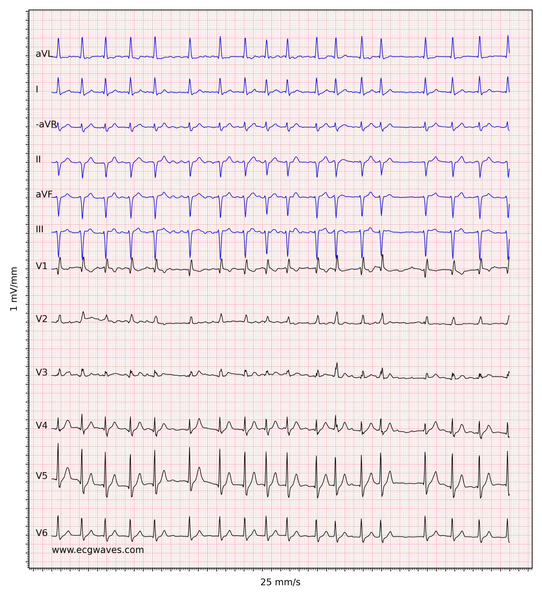 Atrieflimmer: EKG, klassifisering, årsaker, risikofaktorer og behandling – Kardiologi Online