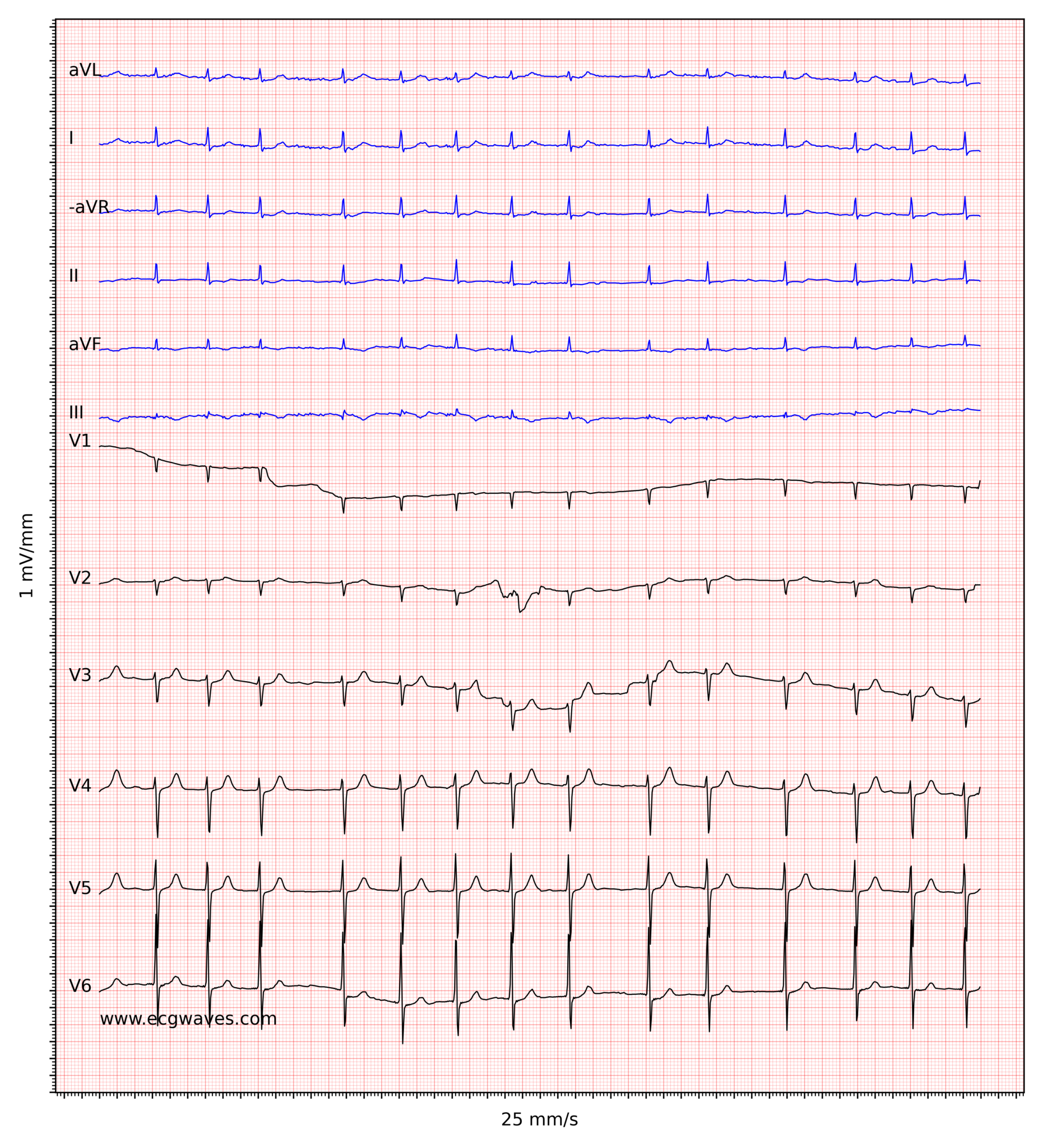 Atrieflimmer: EKG, klassifisering, årsaker, risikofaktorer og behandling – Kardiologi Online