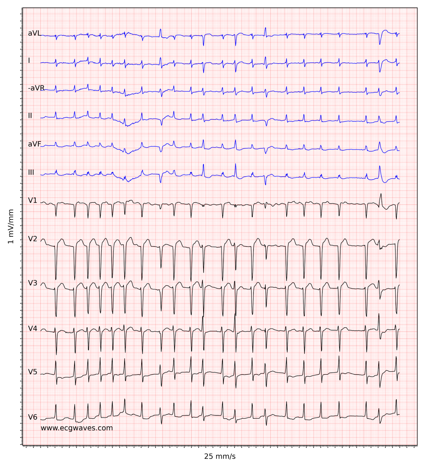 Atrieflimmer: EKG, klassifisering, årsaker, risikofaktorer og ...