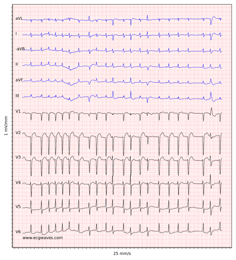 Atrieflimmer: EKG, klassifisering, årsaker, risikofaktorer og behandling – Kardiologi Online