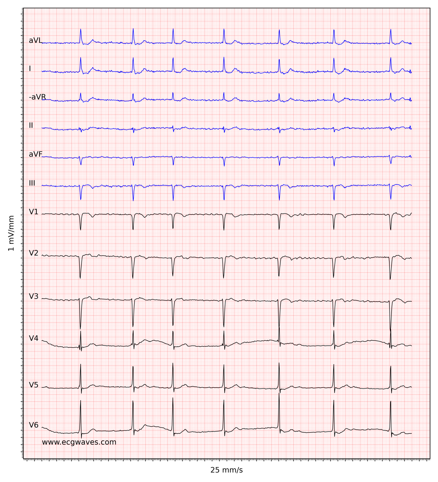 Atrieflimmer: EKG, klassifisering, årsaker, risikofaktorer og ...