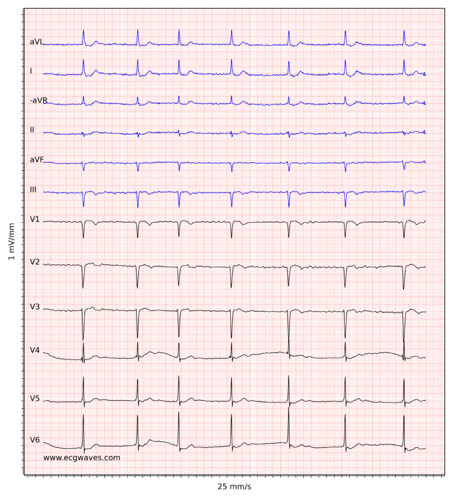 Atrieflimmer: EKG, klassifisering, årsaker, risikofaktorer og behandling – Kardiologi Online