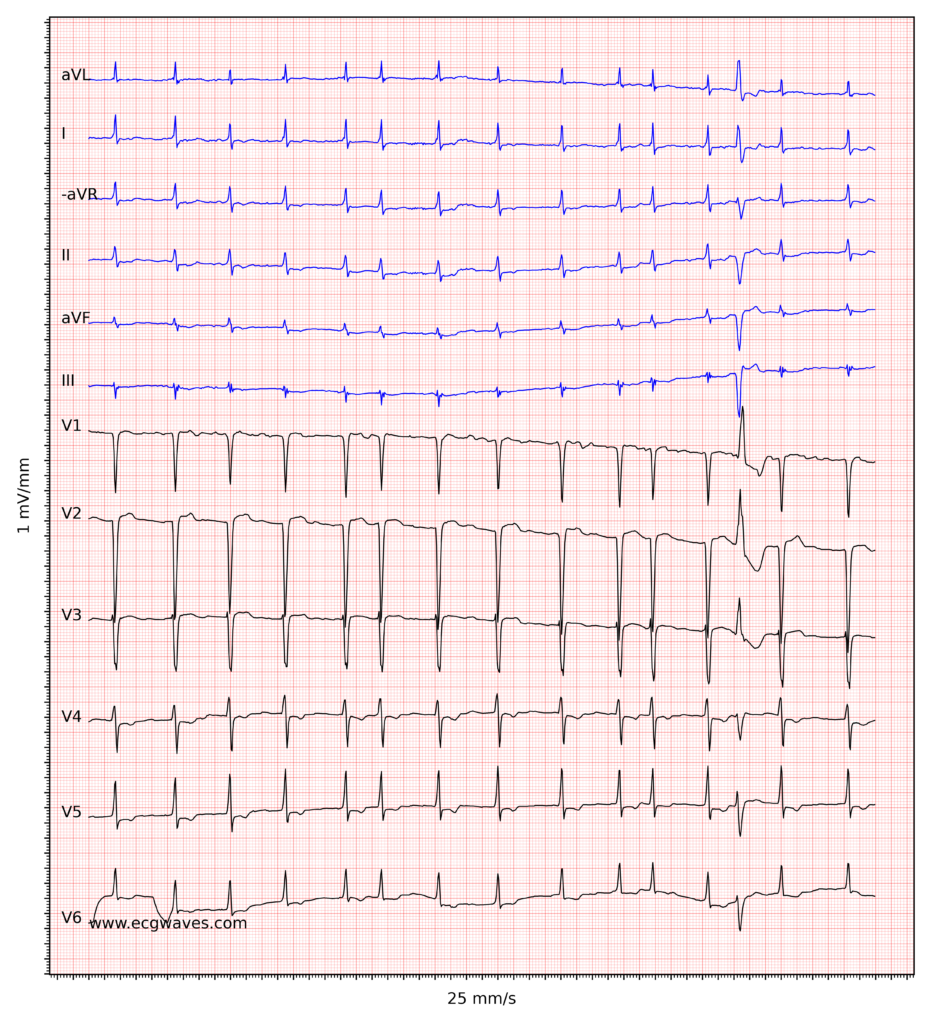 Atrieflimmer: EKG, klassifisering, årsaker, risikofaktorer og behandling – Kardiologi Online