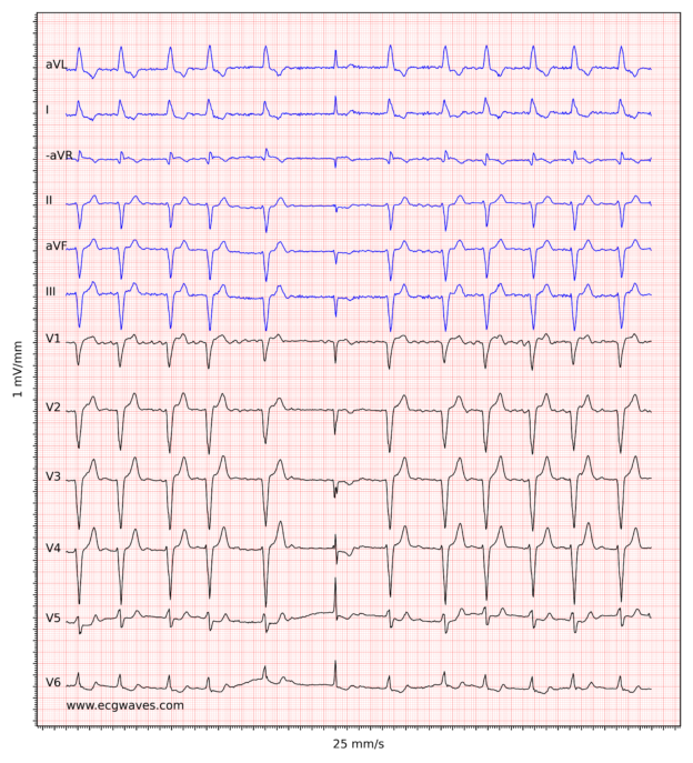 Atrieflimmer: EKG, klassifisering, årsaker, risikofaktorer og behandling – Kardiologi Online