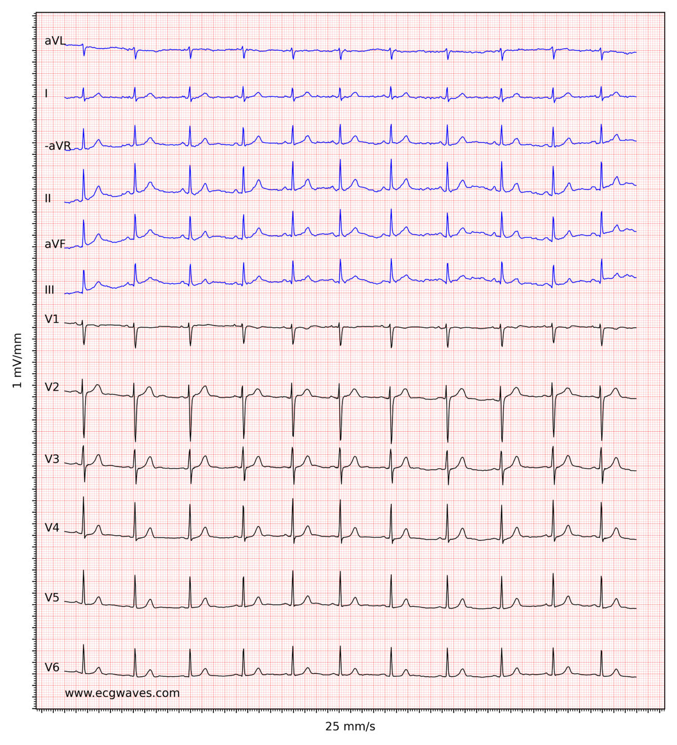 Tolkning av EKG: Kjennetegn ved et normalt EKG (P-bølge, QRS-kompleks ...