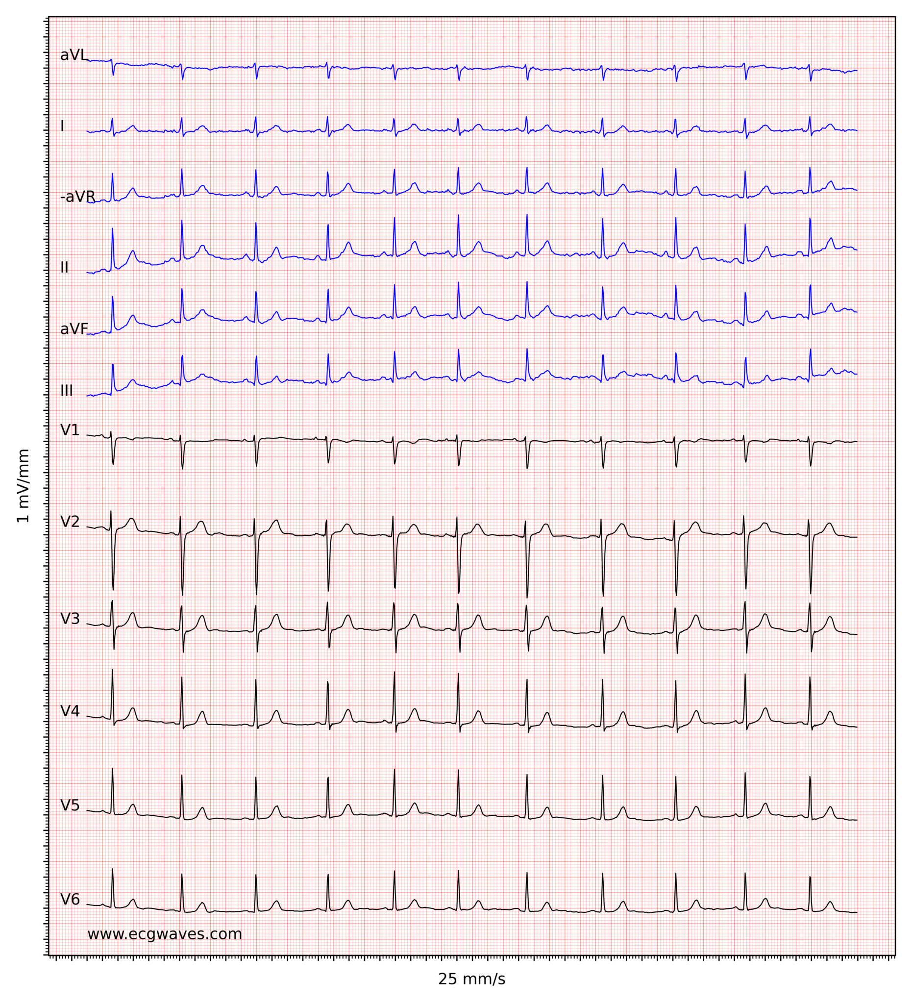 Tolkning av EKG: Kjennetegn ved et normalt EKG (P-bølge, QRS-kompleks ...