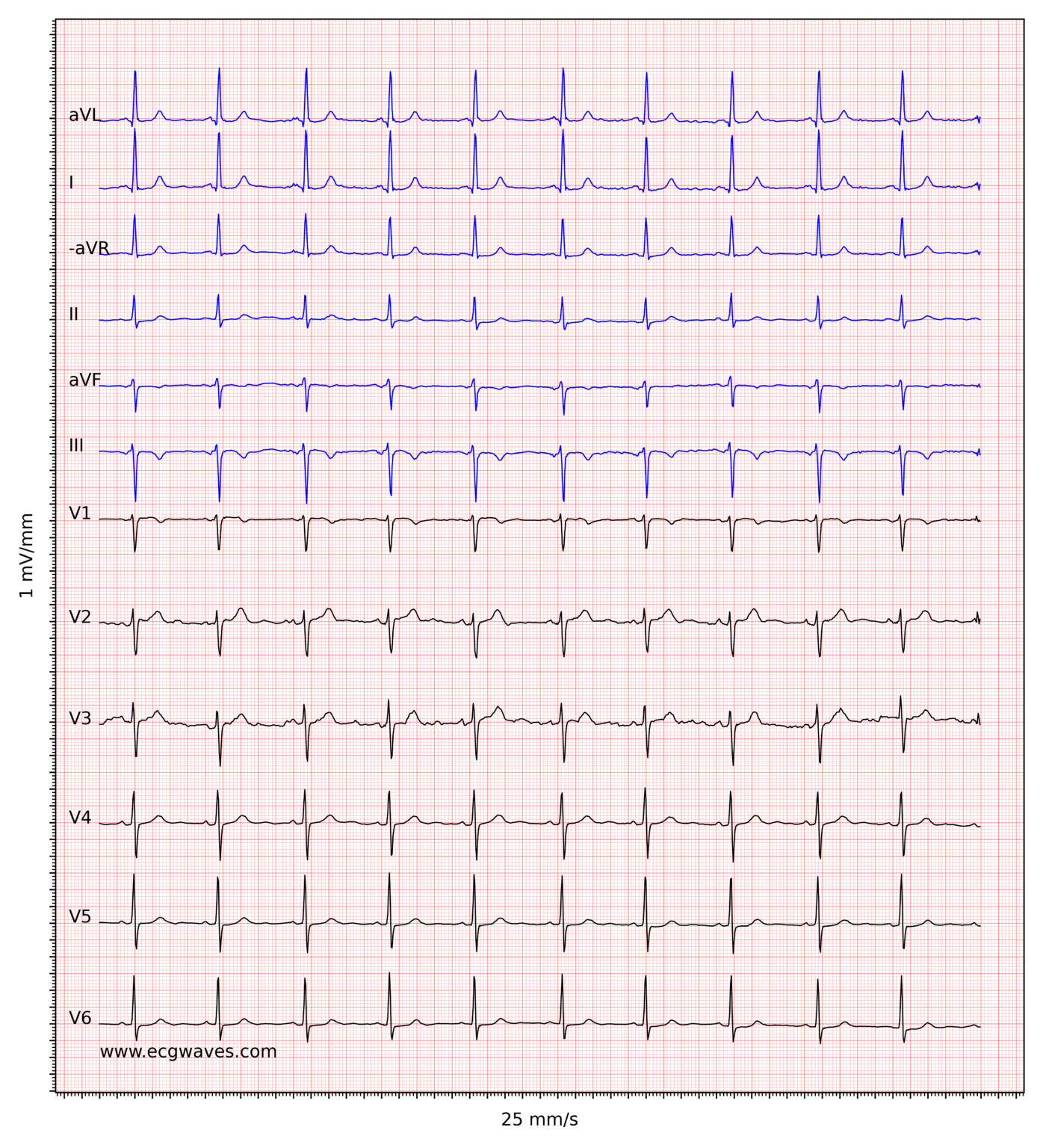 Tolkning av EKG: Kjennetegn ved et normalt EKG (P-bølge, QRS-kompleks ...