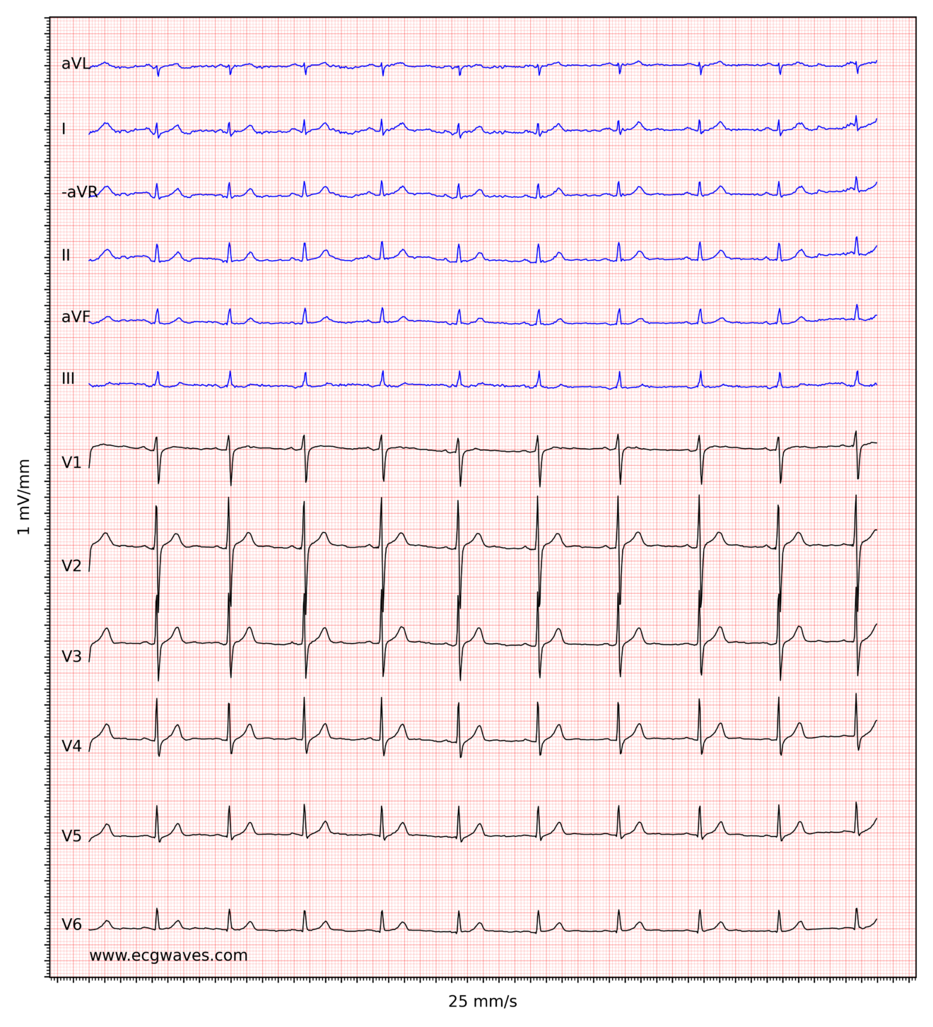 Tolkning av EKG: Kjennetegn ved et normalt EKG (P-bølge, QRS-kompleks ...