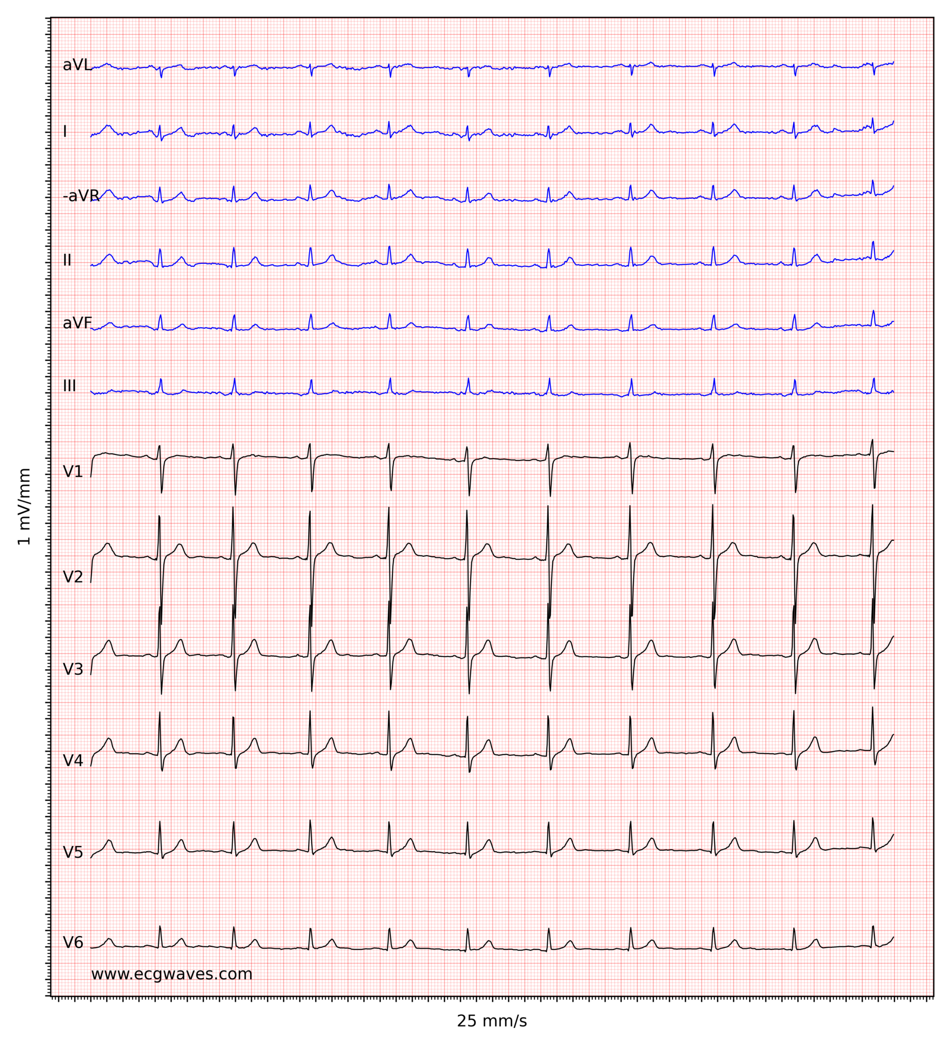 Tolkning av EKG: Kjennetegn ved et normalt EKG (P-bølge, QRS-kompleks ...