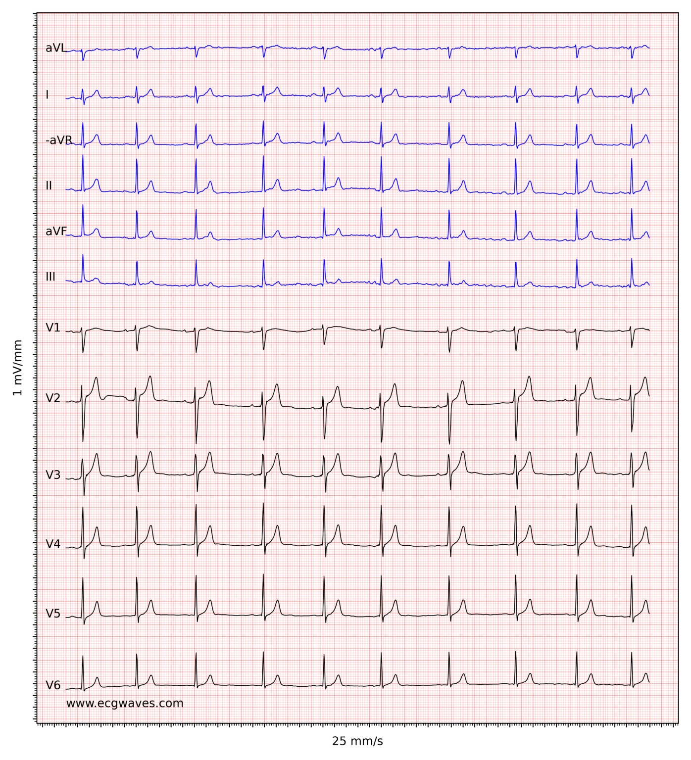 Tolkning av EKG: Kjennetegn ved et normalt EKG (P-bølge, QRS-kompleks ...
