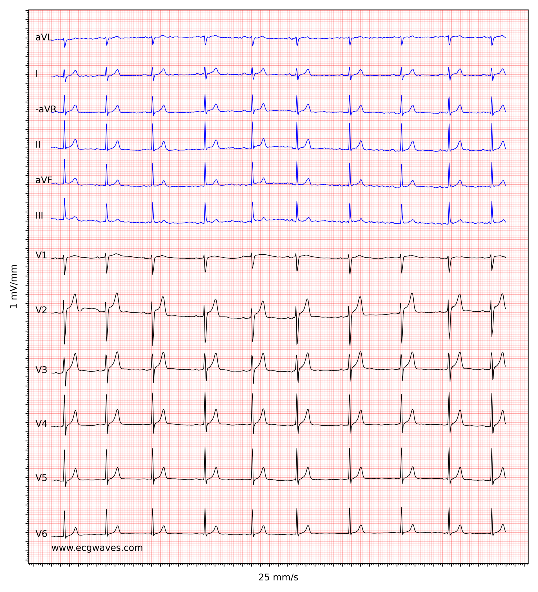 Tolkning av EKG: Kjennetegn ved et normalt EKG (P-bølge, QRS-kompleks ...