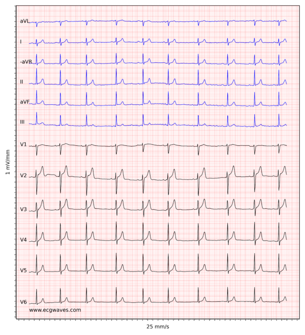Tolkning av EKG: Kjennetegn ved et normalt EKG (P-bølge, QRS-kompleks ...