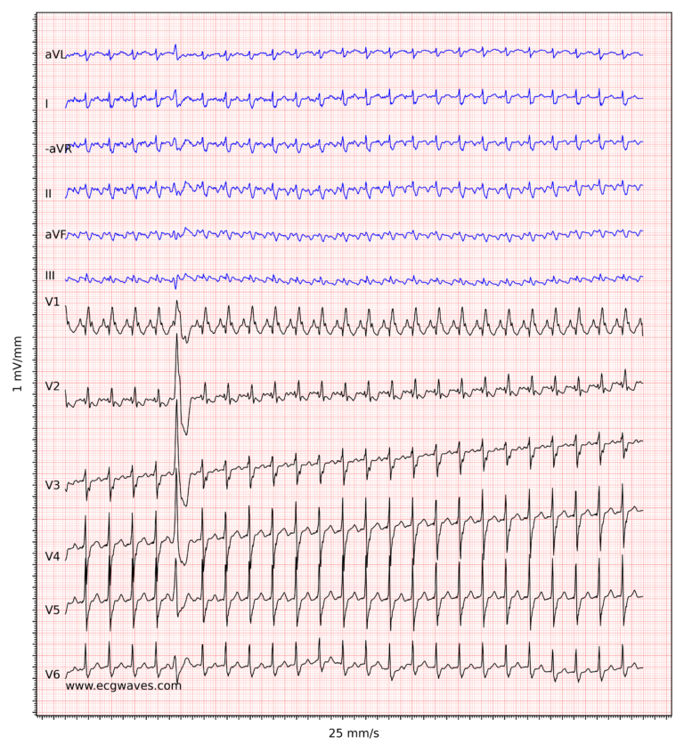 Atrieflutter: klassifisering, årsaker, EKG-kriterier og behandling – Kardiologi Online
