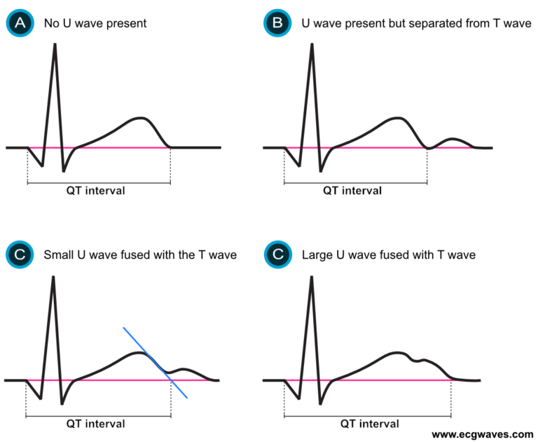 QT-varighet og korrigert QT-varighet (QTc): EKG-egenskaper og ...