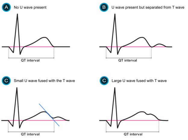 Langt QT-intervall (QTc), langt QT-syndrom (LQTS) og torsades de ...