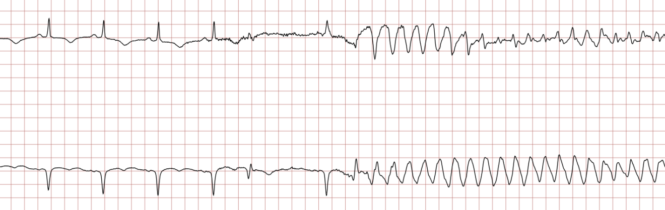 Ventrikulær takykardi (VT): EKG-kriterier, årsaker, klassifisering ...
