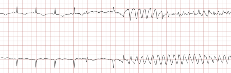 Ventrikulær takykardi (VT): EKG-kriterier, årsaker, klassifisering ...