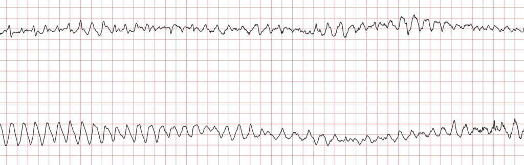 Ventrikulær takykardi (VT): EKG-kriterier, årsaker, klassifisering ...