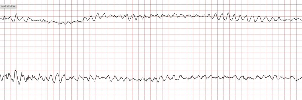 Ventrikulær takykardi (VT): EKG-kriterier, årsaker, klassifisering ...