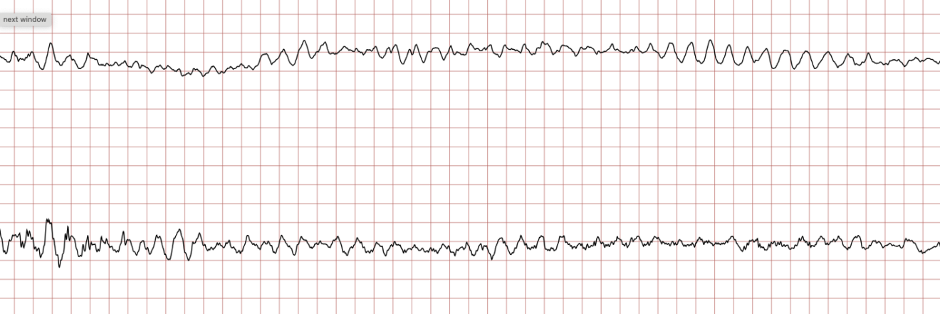 Ventrikulær takykardi (VT): EKG-kriterier, årsaker, klassifisering ...