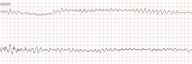Ventrikulær takykardi (VT): EKG-kriterier, årsaker, klassifisering ...
