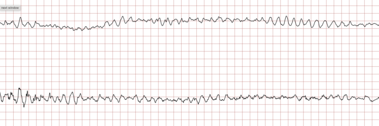 Ventrikulær takykardi (VT): EKG-kriterier, årsaker, klassifisering ...