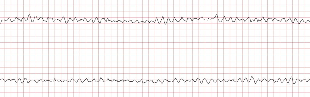 Ventrikulær takykardi (VT): EKG-kriterier, årsaker, klassifisering ...