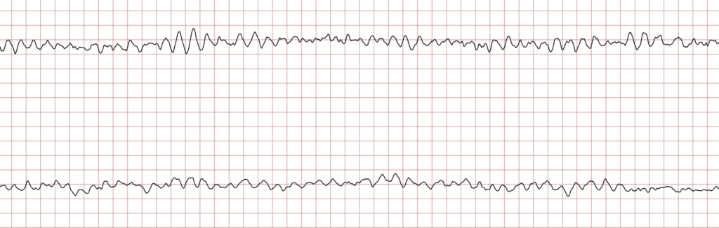 Ventrikulær takykardi (VT): EKG-kriterier, årsaker, klassifisering ...
