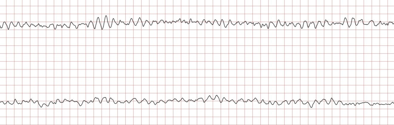 Ventrikulær takykardi (VT): EKG-kriterier, årsaker, klassifisering ...