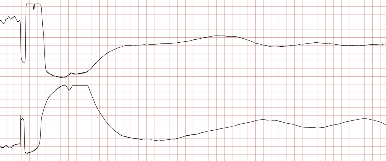 Ventrikulær takykardi (VT): EKG-kriterier, årsaker, klassifisering ...