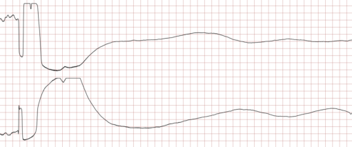Ventrikulær takykardi (VT): EKG-kriterier, årsaker, klassifisering ...