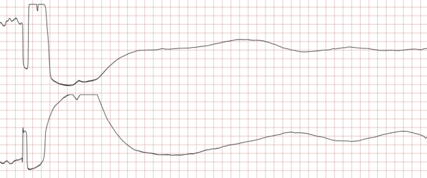 Ventrikulær takykardi (VT): EKG-kriterier, årsaker, klassifisering ...